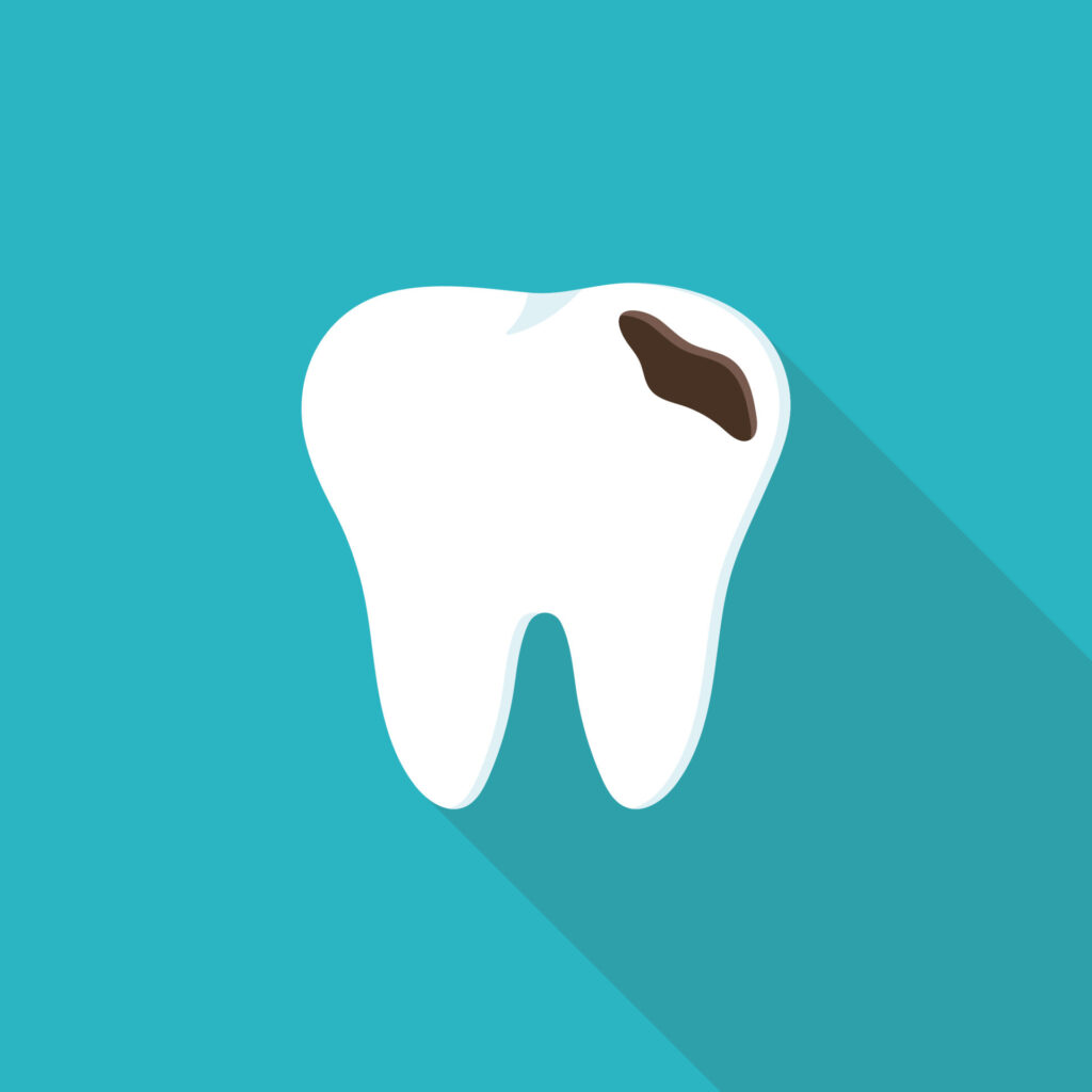 tooth cavities/tooth decay: causes, symptoms, prevention - kidodent